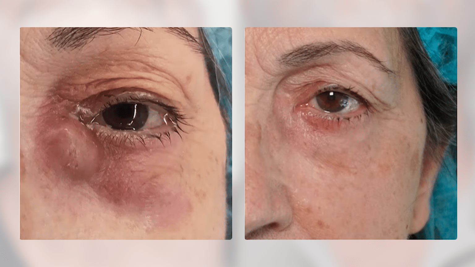 Lacrimal pathway and tears - Faces Facial Surgery in Lisboa and Evora